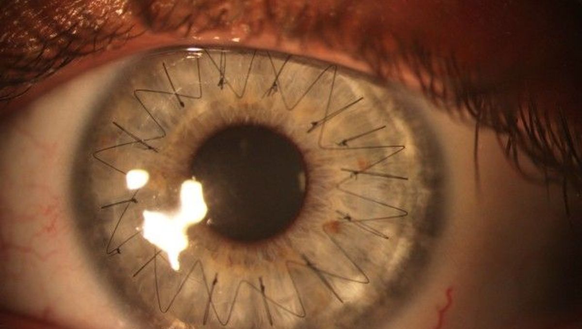 What Do Eye Stitches Look Like? | IFLScience