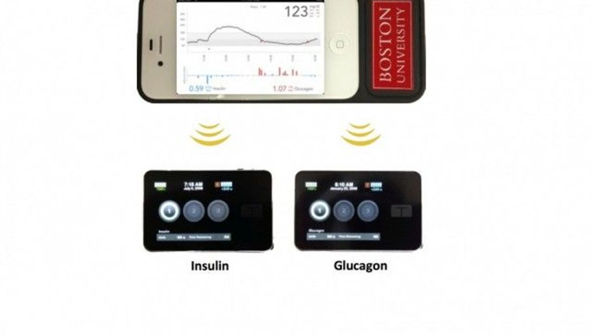 Scientists Develop Bionic Pancreas For Type 1 Diabetics | IFLScience