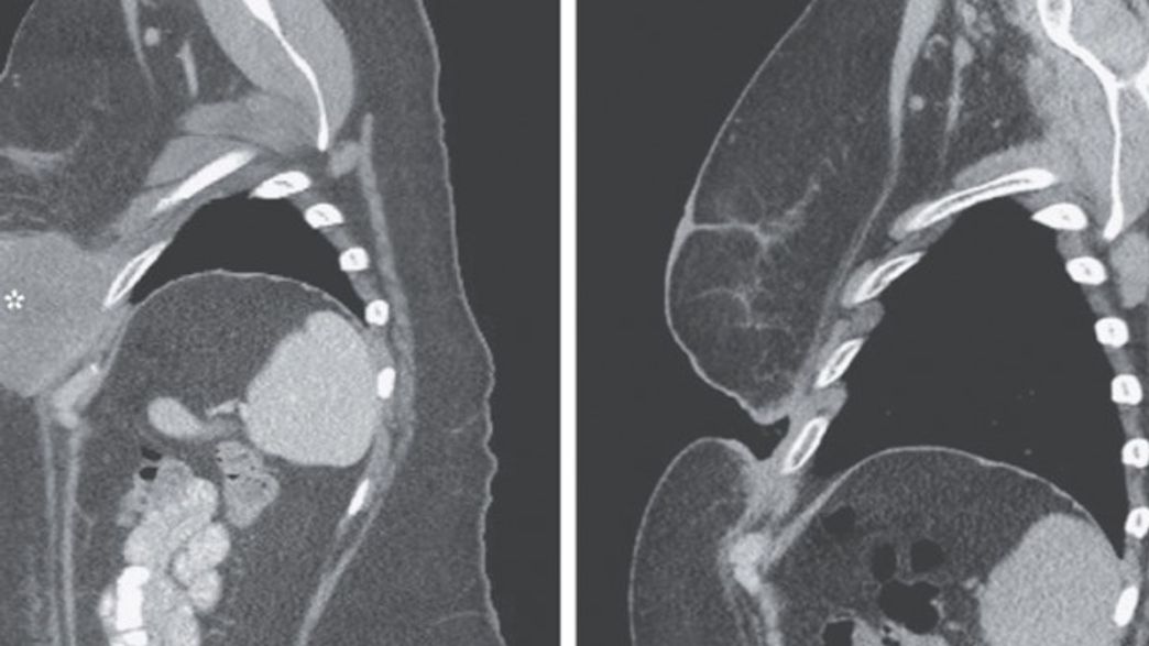 New Cancer Therapy "Dissolves" Woman's Tumor In 3 Weeks | IFLScience