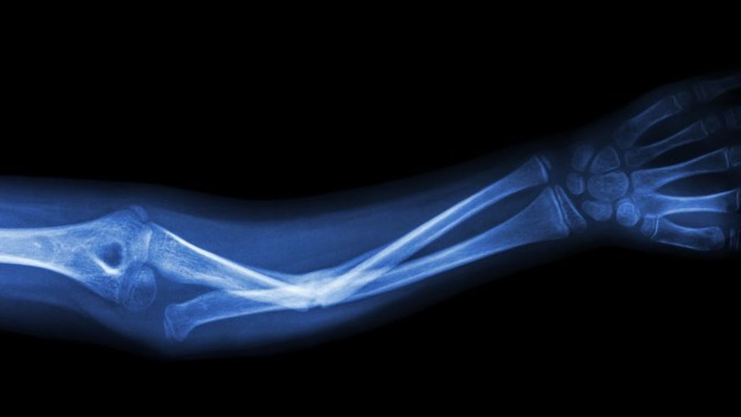 Young Blood Speeds Healing Of Old Broken Bones | IFLScience