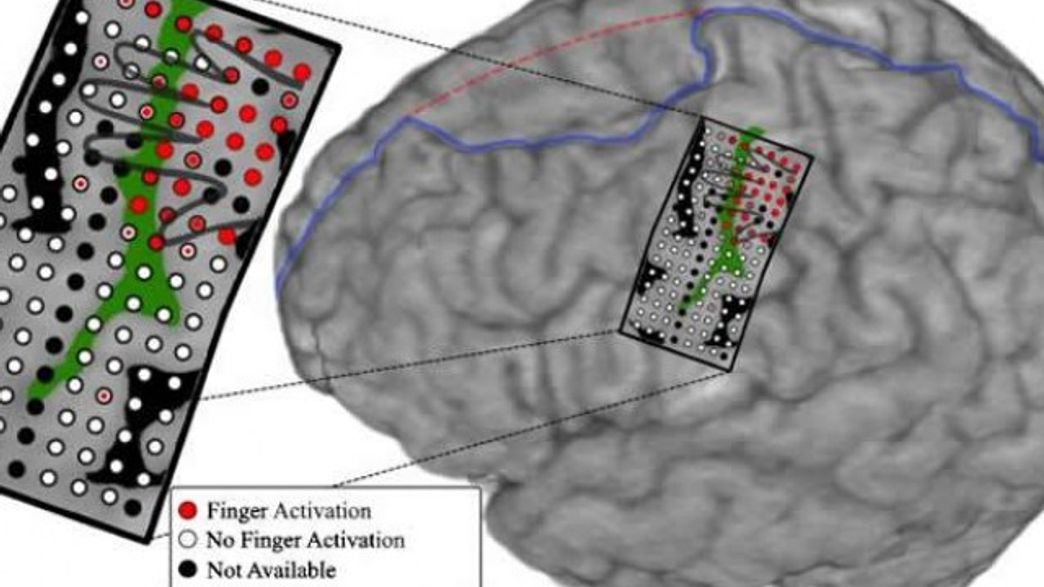 New Mind-Controlled Prosthetic Hand Can Move Each Finger Individually ...