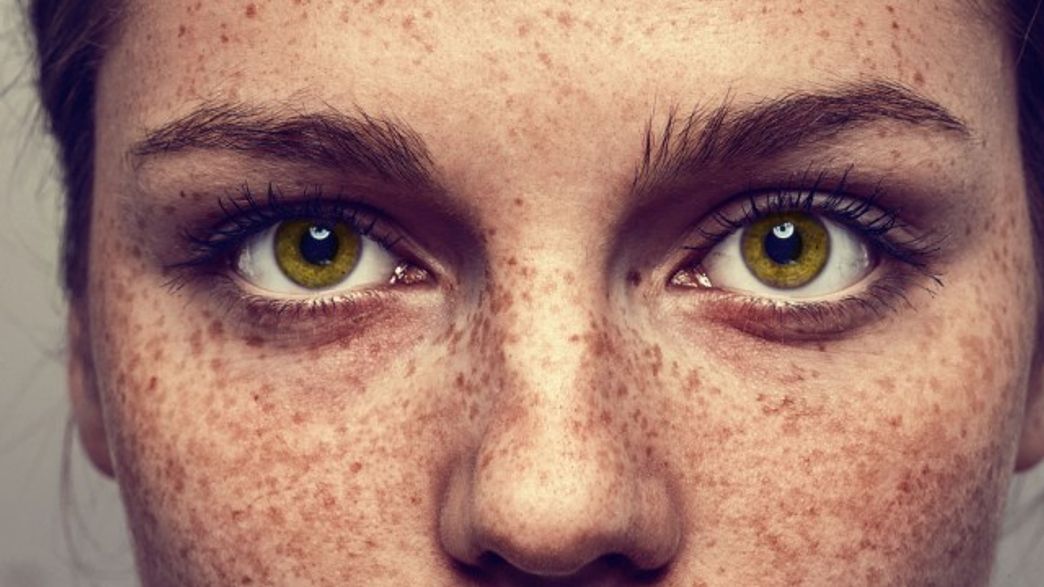 Why Do People Have Freckles? | IFLScience