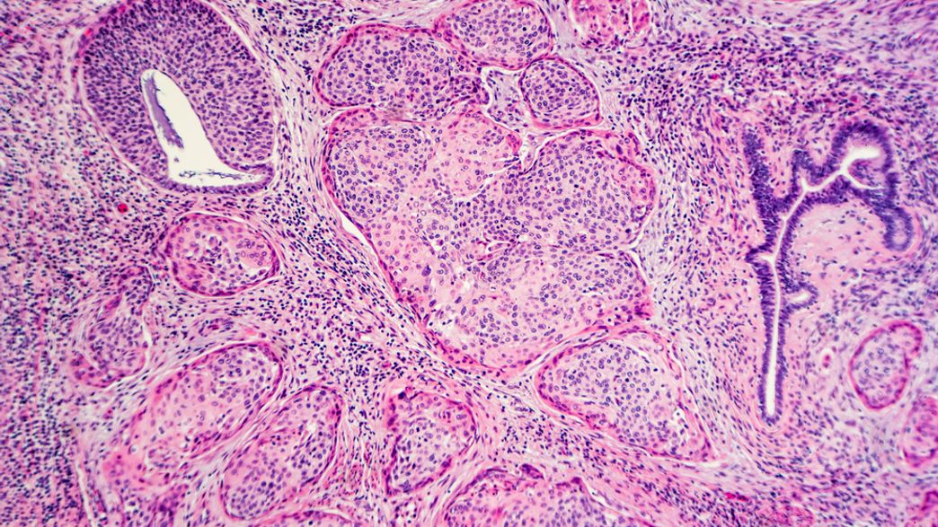 Vaccines Against HPV Really Do Reduce Cervical Cancer Rates | IFLScience