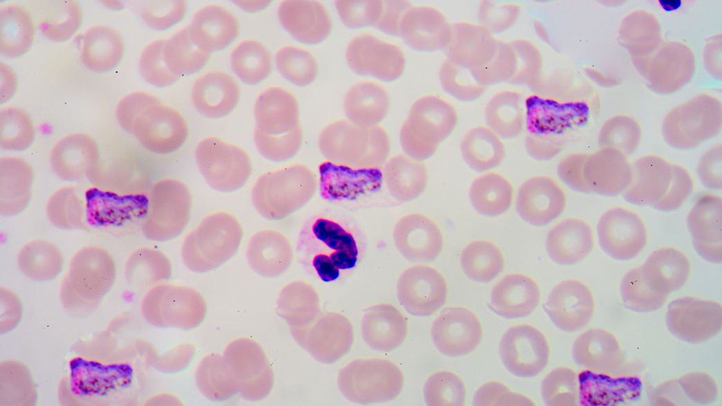 Patients Diagnosed With Drug-Resistant Malaria In The UK For The First ...