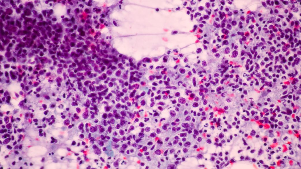 Researchers Find A Way To Reverse Drug Resistance In Tuberculosis ...