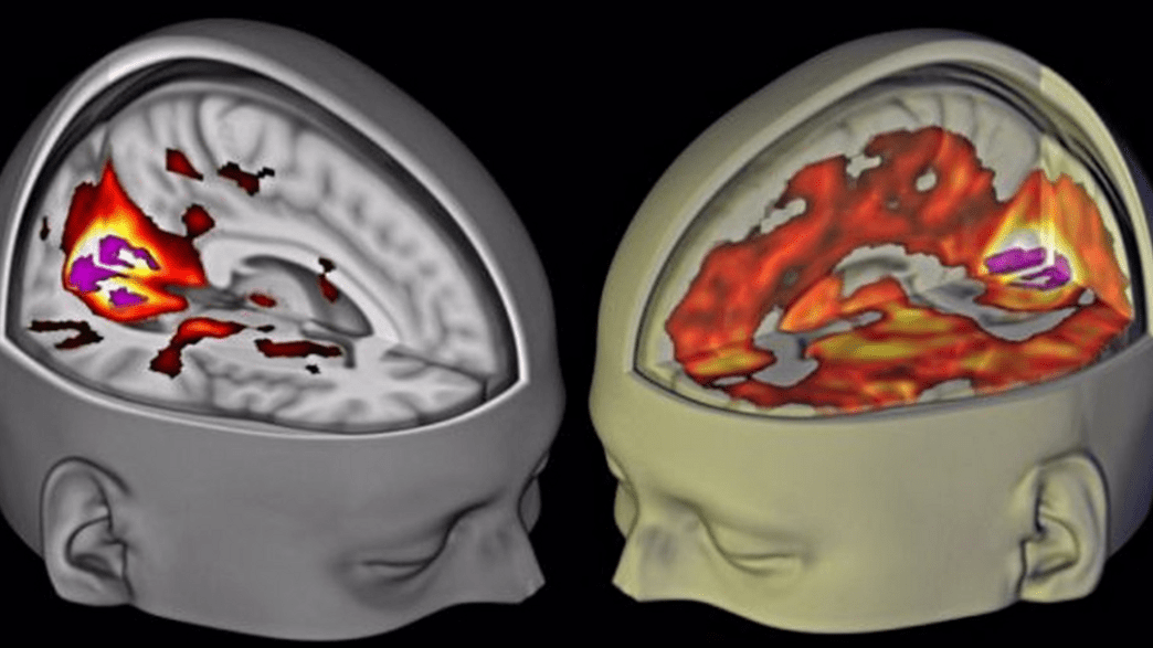 Scientists Want To Study LSD Microdosing For The First Time, But They ...