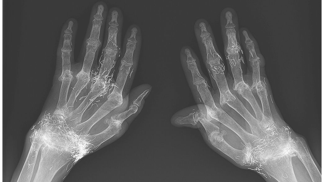 X-Rays Show Gold Splinters Embedded In Woman's Hands | IFLScience