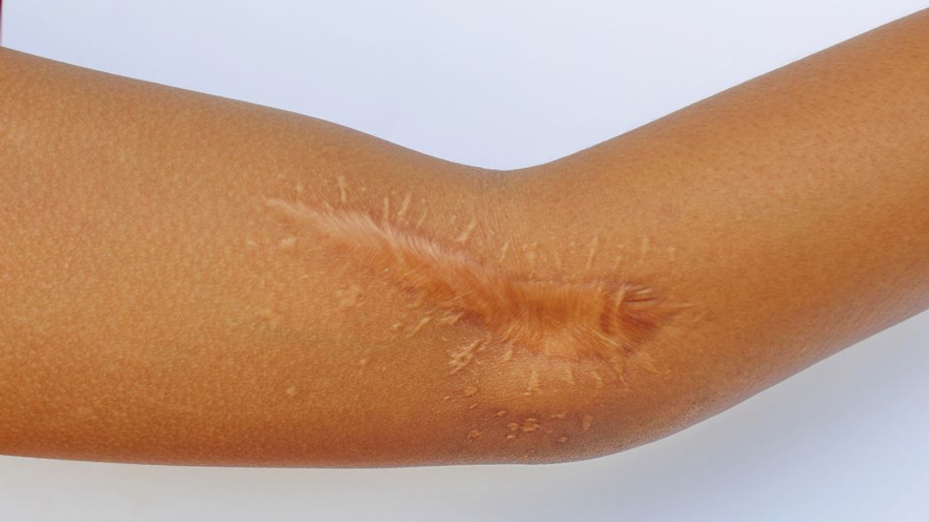 Fetal Protein Band-Aids Could Let Wounds Heal Without Visible Scars ...