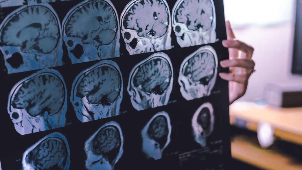 A Single Concussion Can Dramatically Increase Your Chances Of ...