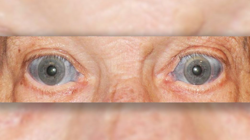 What Turned The Whites Of This Man’s Eyes Blue? | IFLScience