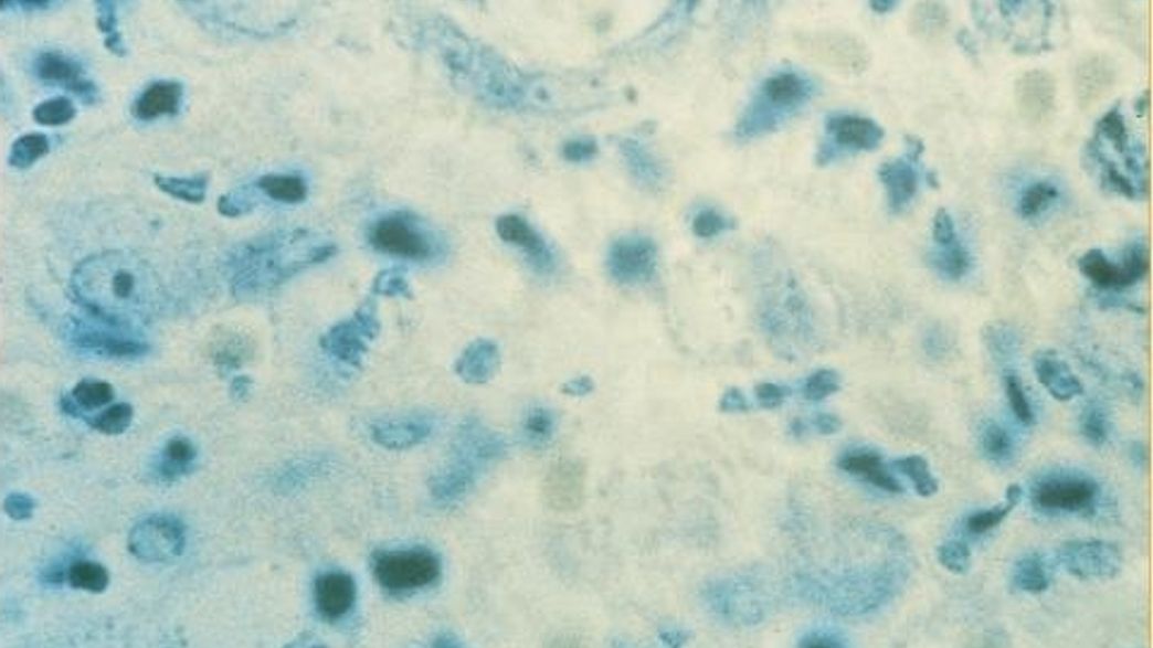 Everything You Need To Know About The New Case Of A "Flesh-Eating" STI ...
