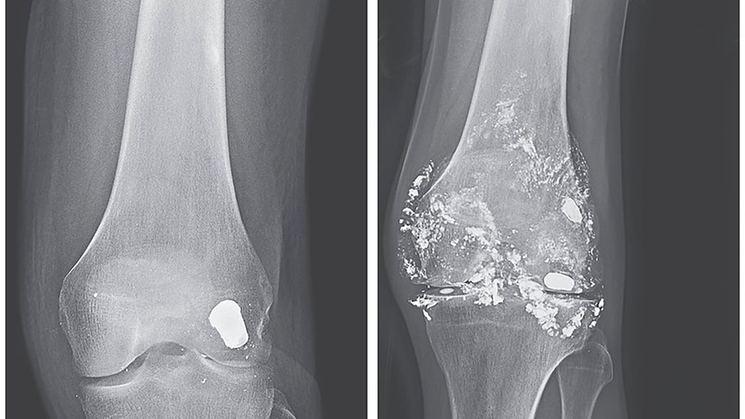 After 14 Years, A Man's Gun Shot Injury Went From Bad To Very Bad ...