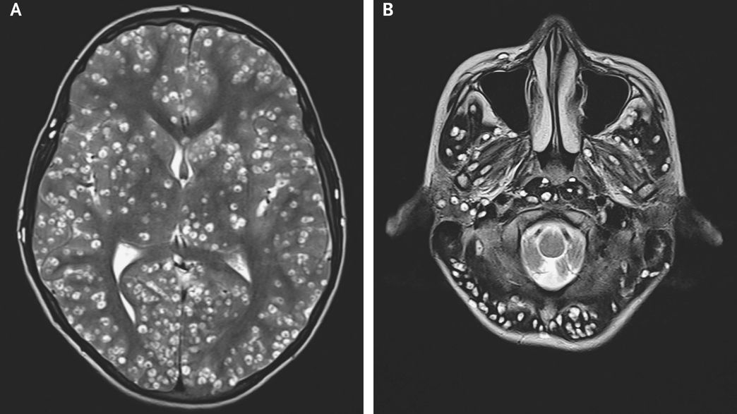 The Strange Dots On This Brain Scan Reveal A Horrific Medical Condition ...
