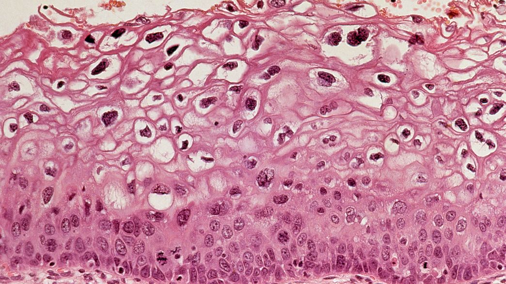The HPV Vaccine Is Dramatically Cutting The Risk Of Cervical Cancer ...