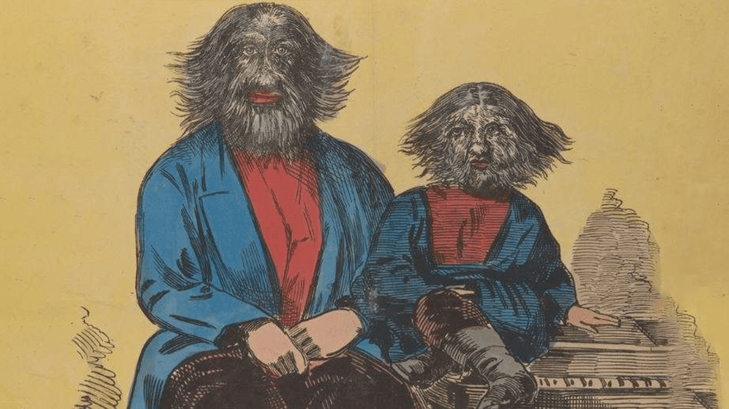 Newborn Babies Develop "Werewolf Syndrome" After Drug Mix-Up | IFLScience