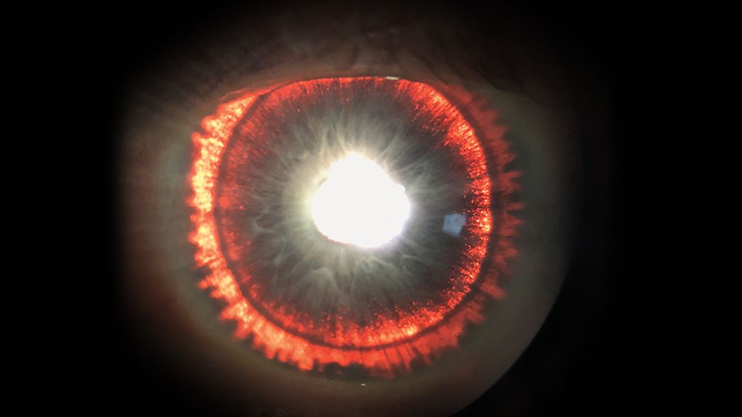 Man’s Eye Exam Revealed Glowing Iris That Led To Rare Syndrome ...