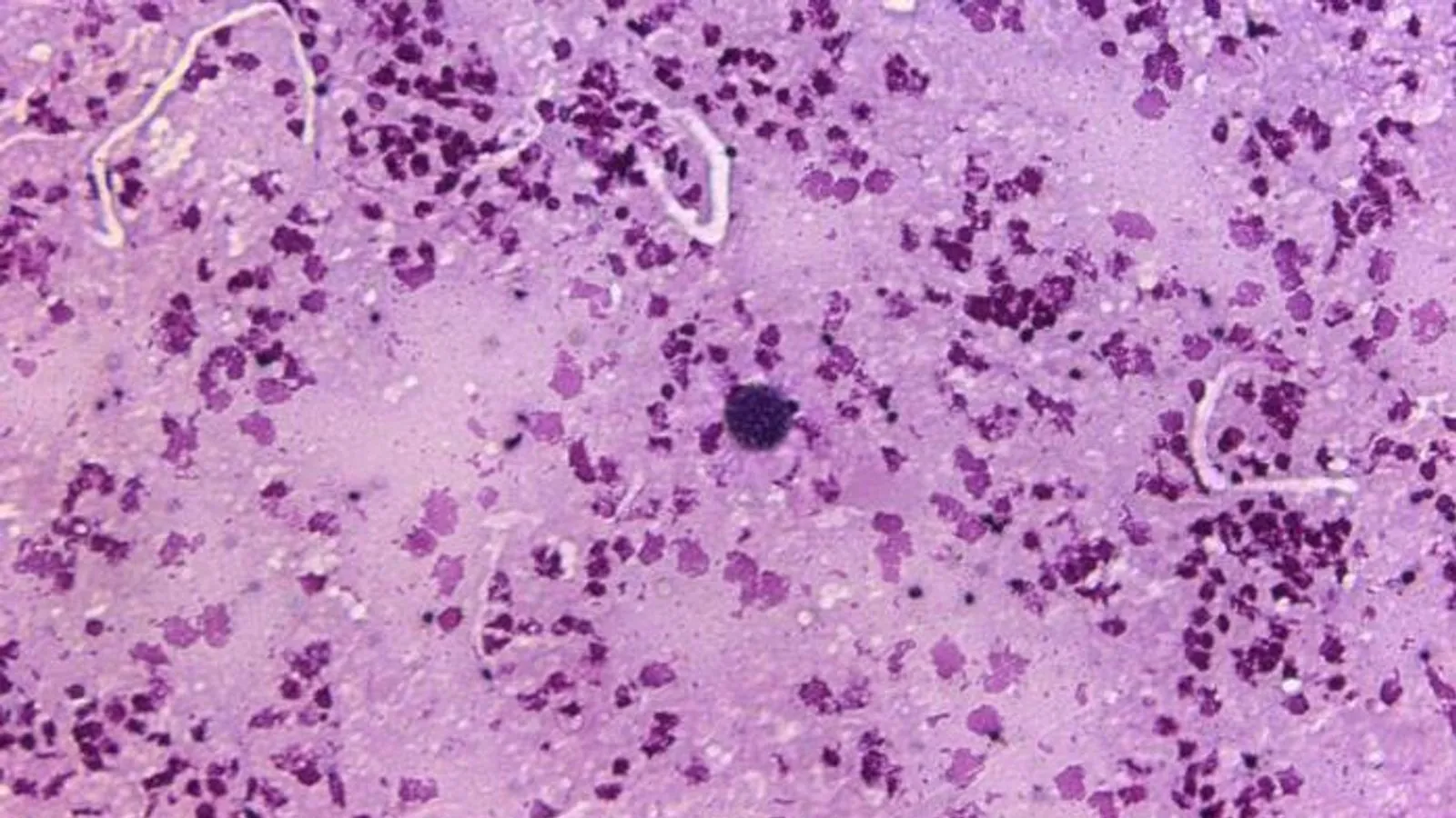 Parasite In Brain