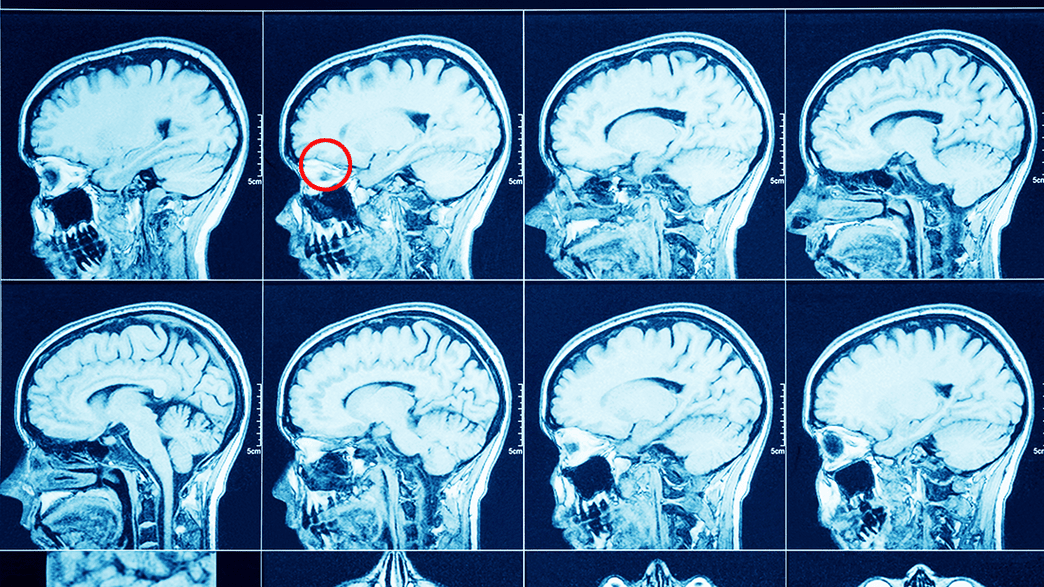 MRI Scans Show Signs Of "Viral Brain Invasion" In Patient With Covid-19 ...