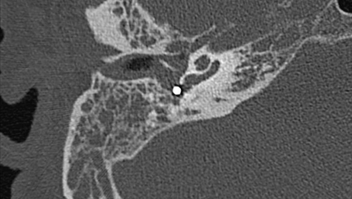 A Welder Got Molten Steel Inside His Ear, Where It Remained For Eight ...