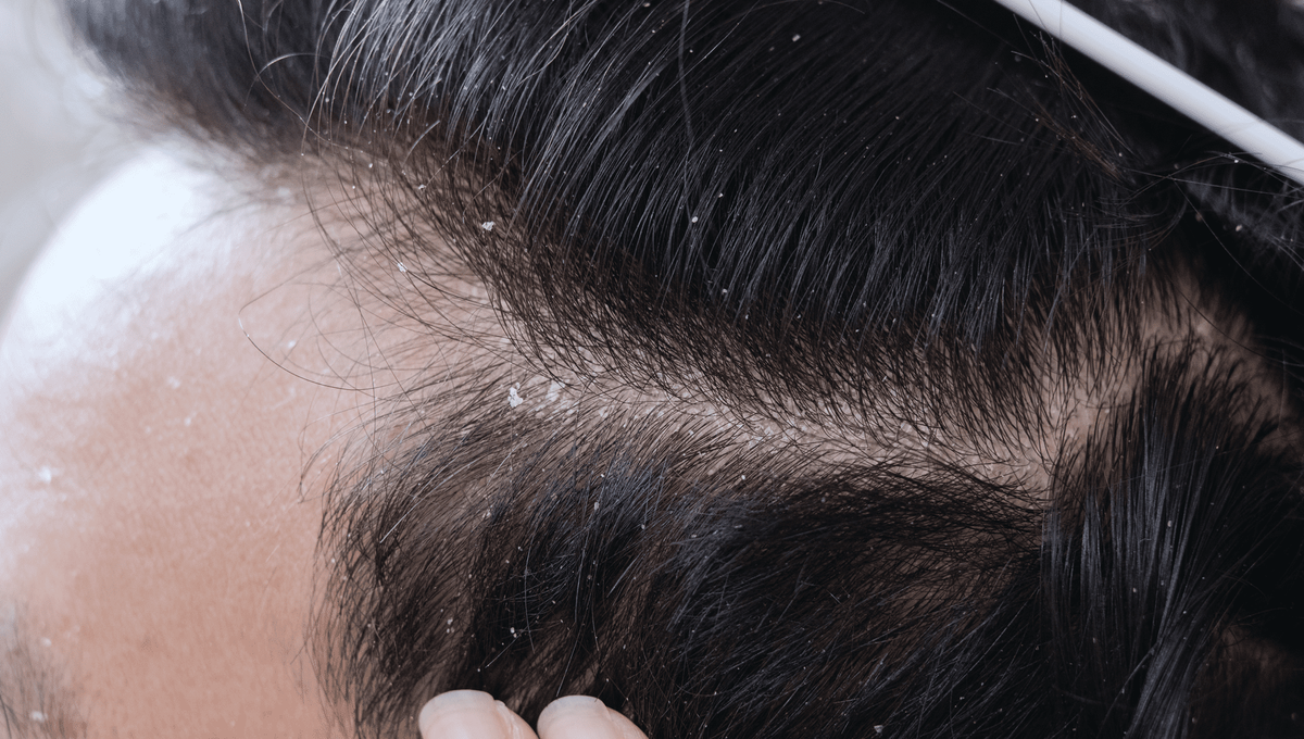 Why Do We Get Dandruff, And How Can We Treat It? | IFLScience