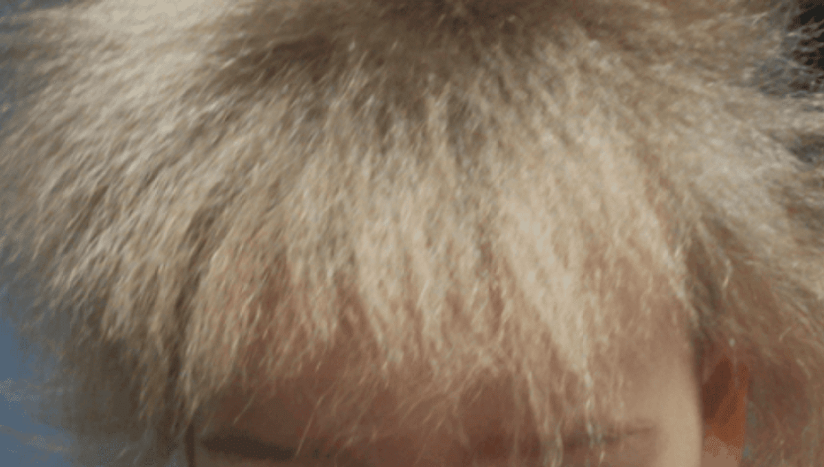 Boy Is One Of 100 In The World With "Uncombable Hair Syndrome" | IFLScience