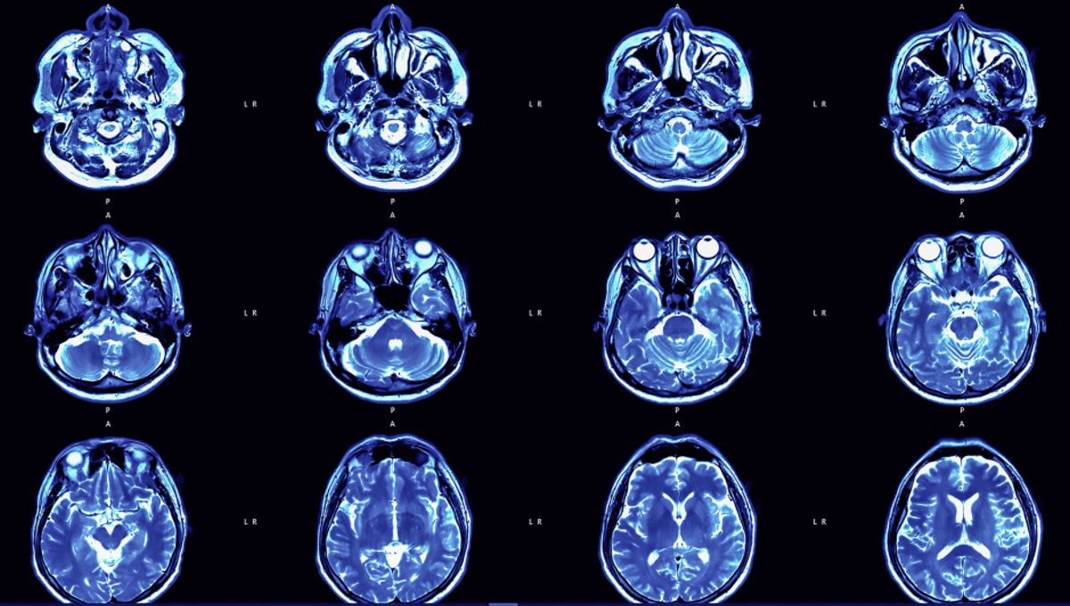 Brain Abscesses Have Skyrocketed In US Children In Last 2 Years, CDC ...