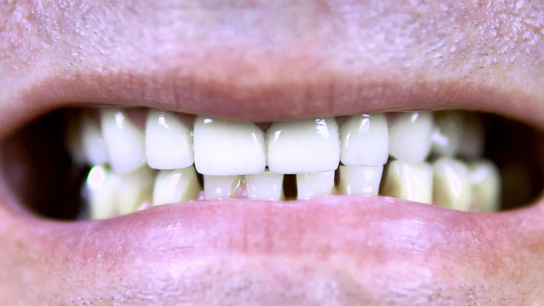 Man Develops "Flesh-Eating Disease" After Being Bitten By Relative At A ...