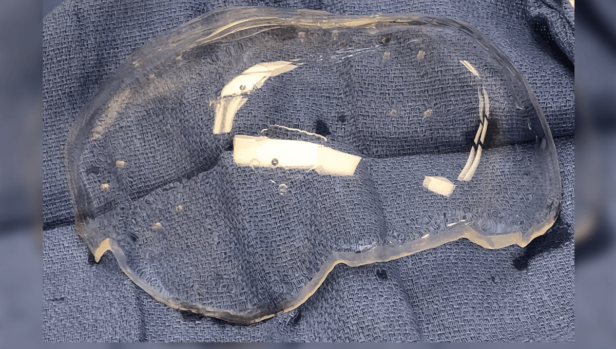 World-First Clear Plastic Skull Implant Opens A Window (Literally) To ...