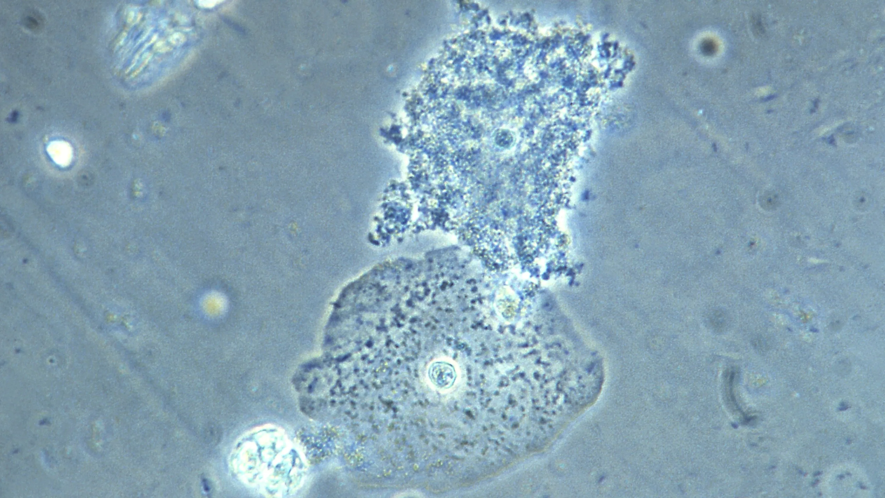 Bacterial Vaginosis In Men