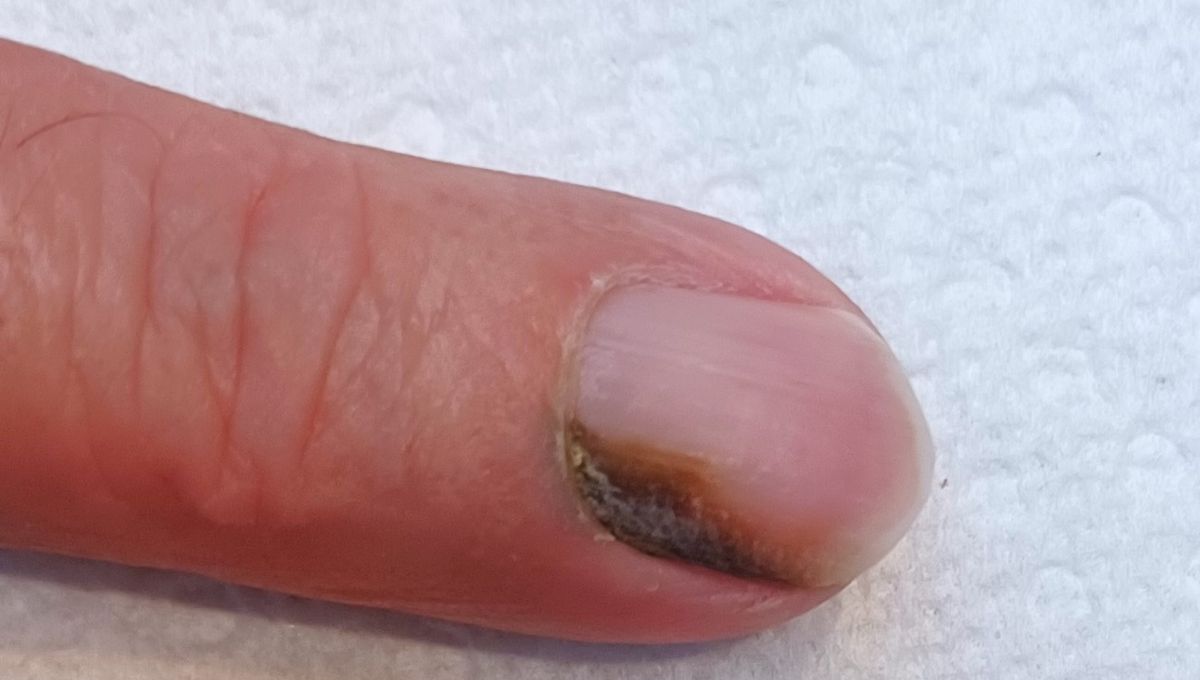 What Is Chloronychia, Otherwise Known As The Goldman-Fox Or Green Nail ...