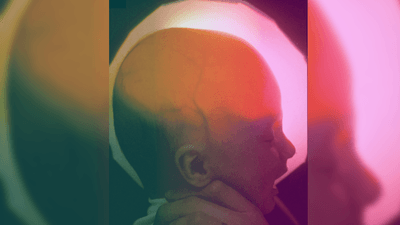 A Woman With Hydranencephaly Just Celebrated Her 20th Birthday. What ...