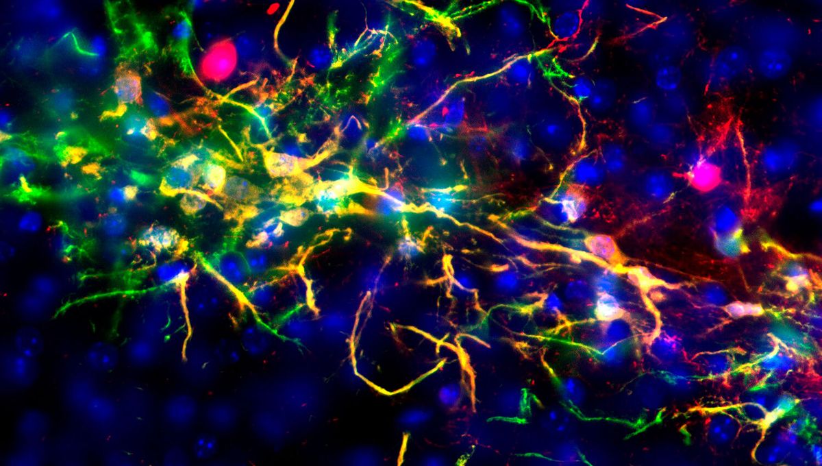 Why Do More Women Than Men Get Alzheimer’s? Scientists Think They’ve ...