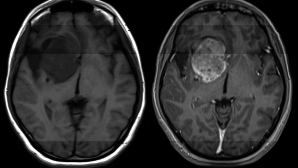 The Most Common Brain Cancer Is Deadly And Incurable. A New ...